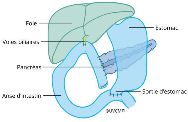 Opération Whipple préservant le pylore | Pankreaszentrum Bern