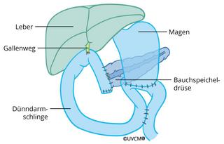Klassische Whipple-Operation - Whipple OP | Pankreaszentrum Bern