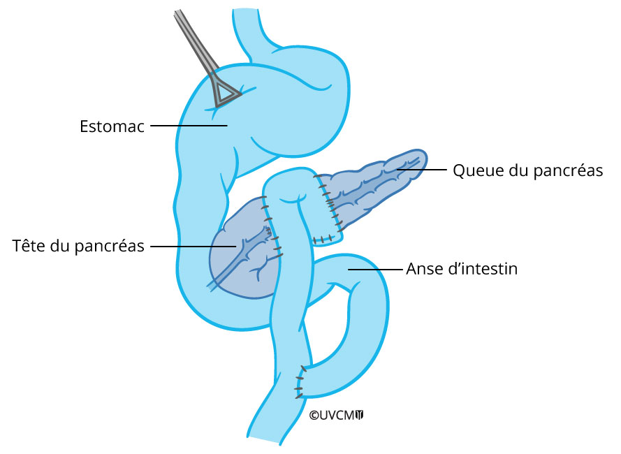 Résection segmentaire du pancréas | Pankreaszentrum Bern